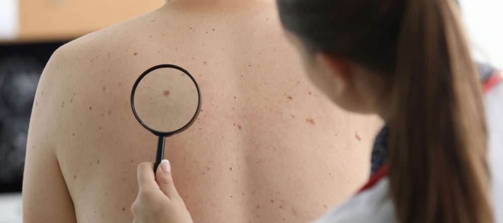 Mole awareness: Non-melanoma and melanoma skin cancer explained - Vita ...